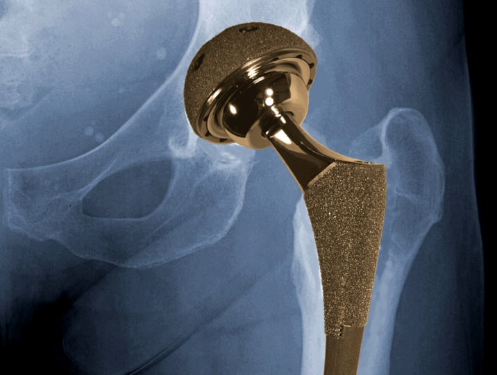 Metal on Metal Hip Implants Lawsuits - Richard Harris Law Firm